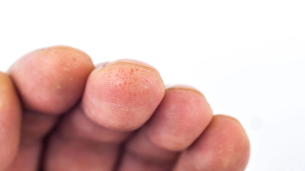 O que é disidrose? Conheça a doença que afeta suas mãos e pés - Super ...