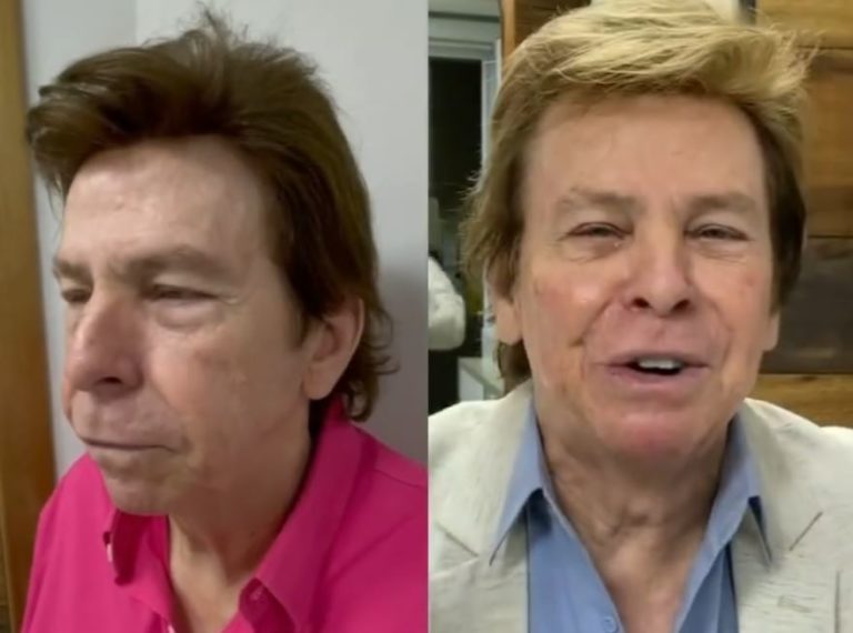 Aos 83 anos, Nelson Rubens se rende e faz harmonização facial - Super ...