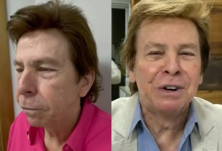 Aos 83 anos, Nelson Rubens se rende e faz harmonização facial - Super ...